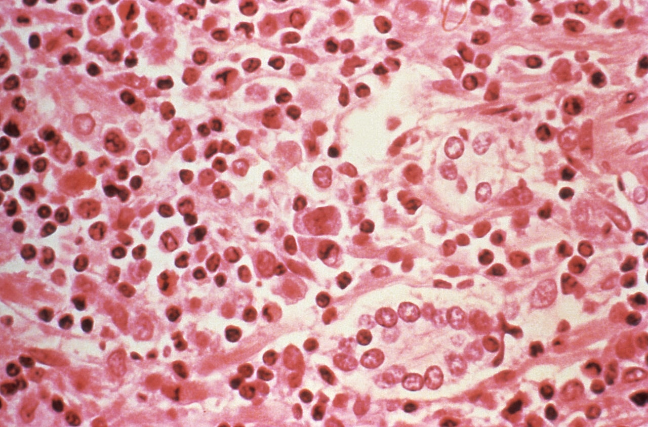 What is hantavirus? What to know about the deadly disease spread by rodents