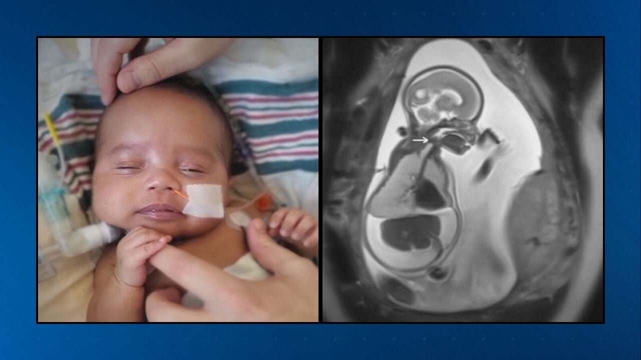 Baby born twice after pioneering surgery in Orlando
