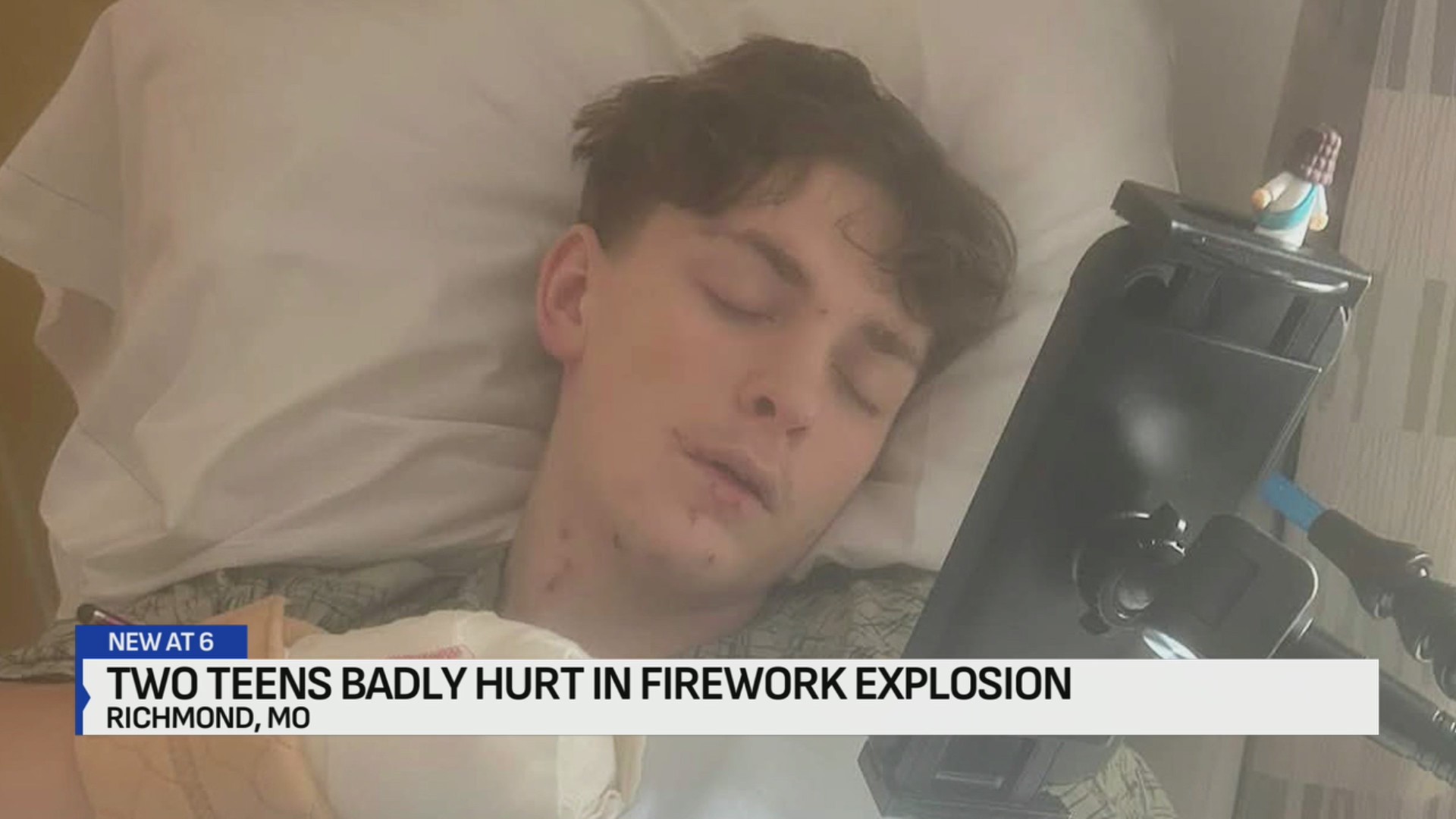 Teen blind in one eye, friend loses hands from firework explosion