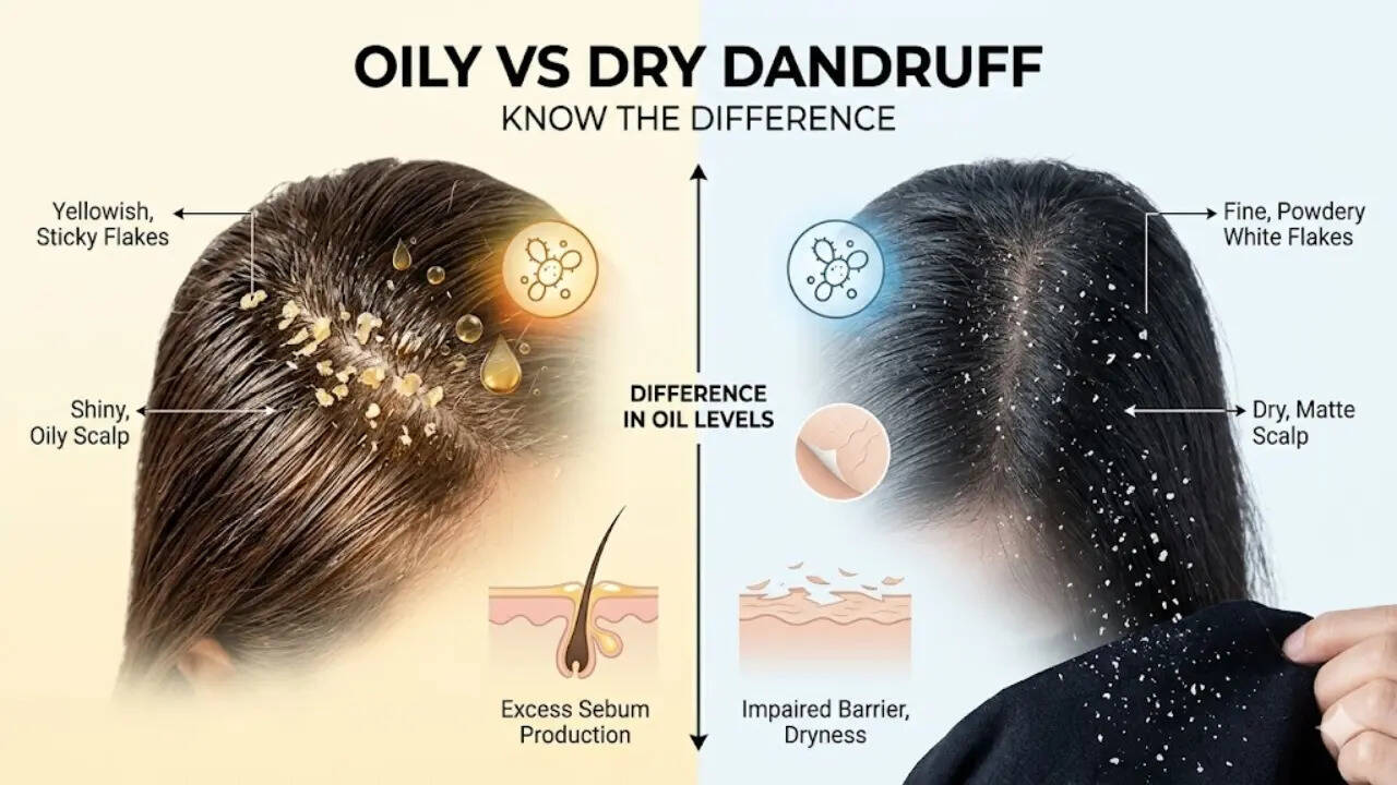 Oily vs dry dandruff: Dermatologist's recommended tips to treat dandruff