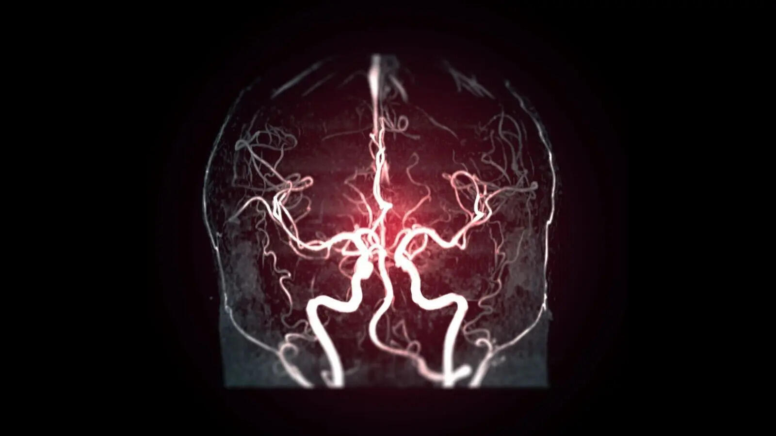 7 silent warning signs that may mean you need a cerebral angiography