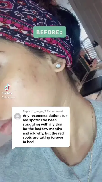 I cleared my red acne marks in 7 days using oatmeal cleanser