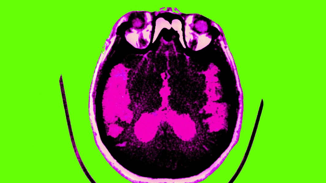 Studies reveal early Alzheimer’s signs and key detection windows