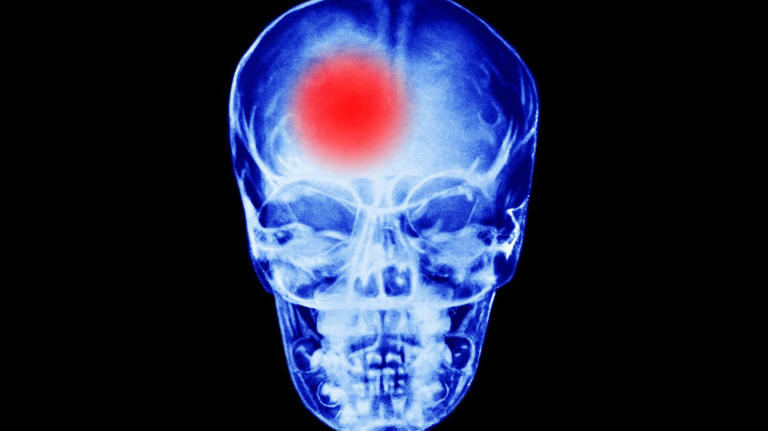 Both very low and very high heart rates may be linked to higher stroke ...