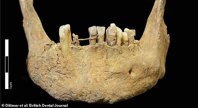 Britain's first grillz? Medieval jaw in Scotland has dental bridge made ...
