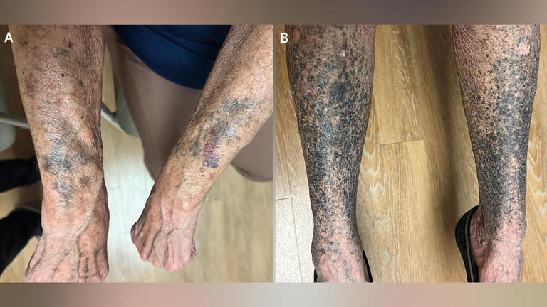 Diagnostic dilemma: A woman turned black and blue weeks after starting ...