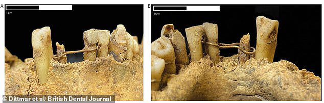 Britain's first grillz? Medieval jaw in Scotland has dental bridge made ...