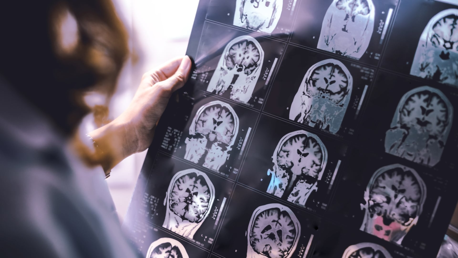 What is Lewy body dementia?