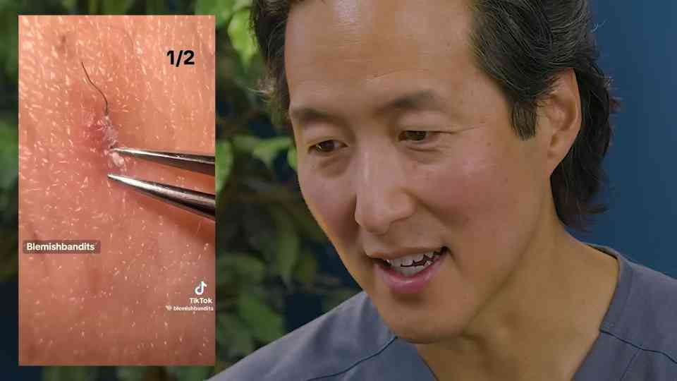 Surgeon reacts to ingrown hair extraction cases