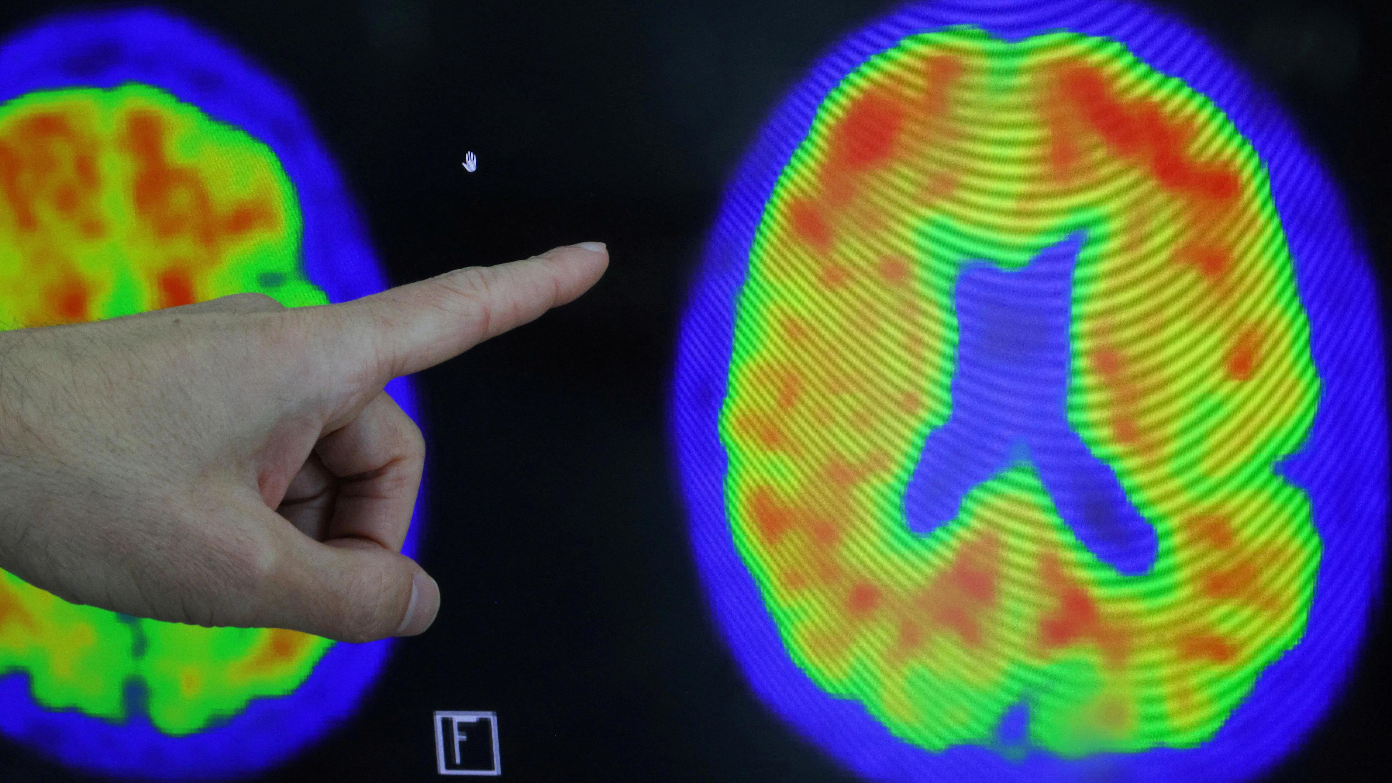 At-home test could spot Alzheimer's risk early