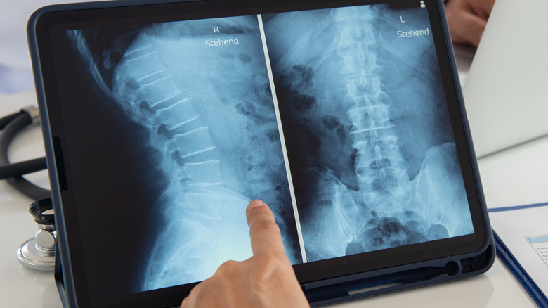 Tips for recovering from back surgery