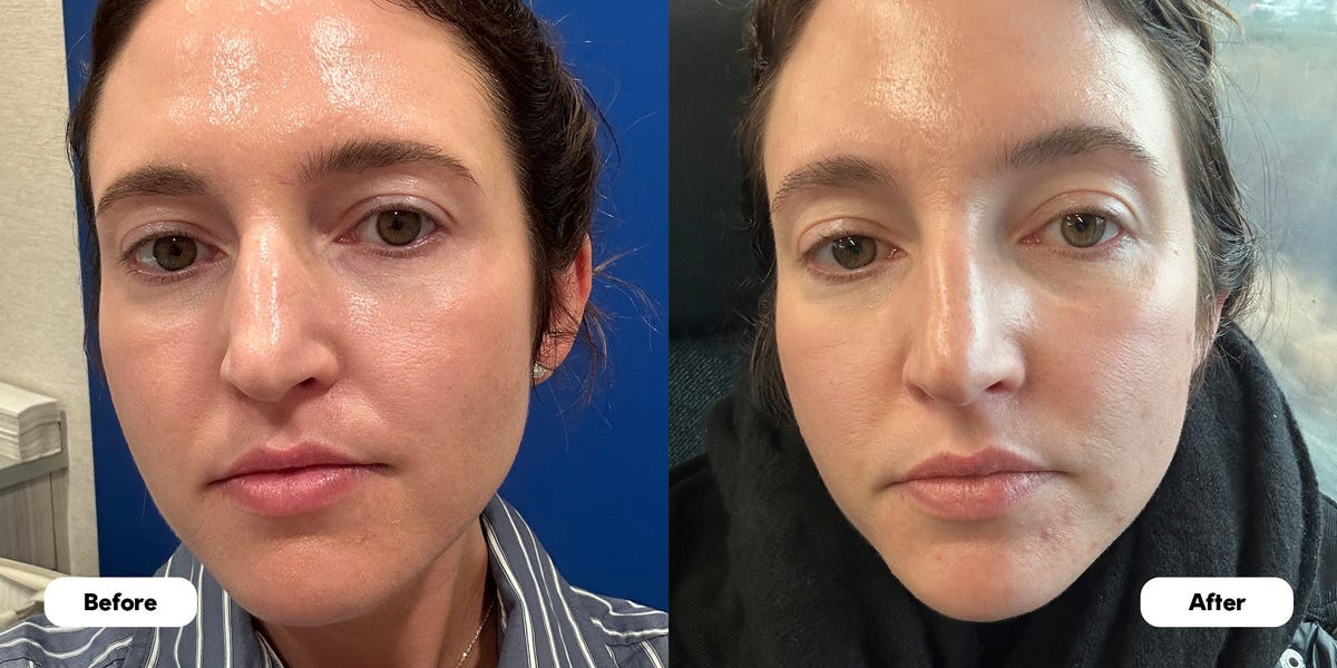 Not fillers, not a laser—the noninvasive treatment that gave me younger ...