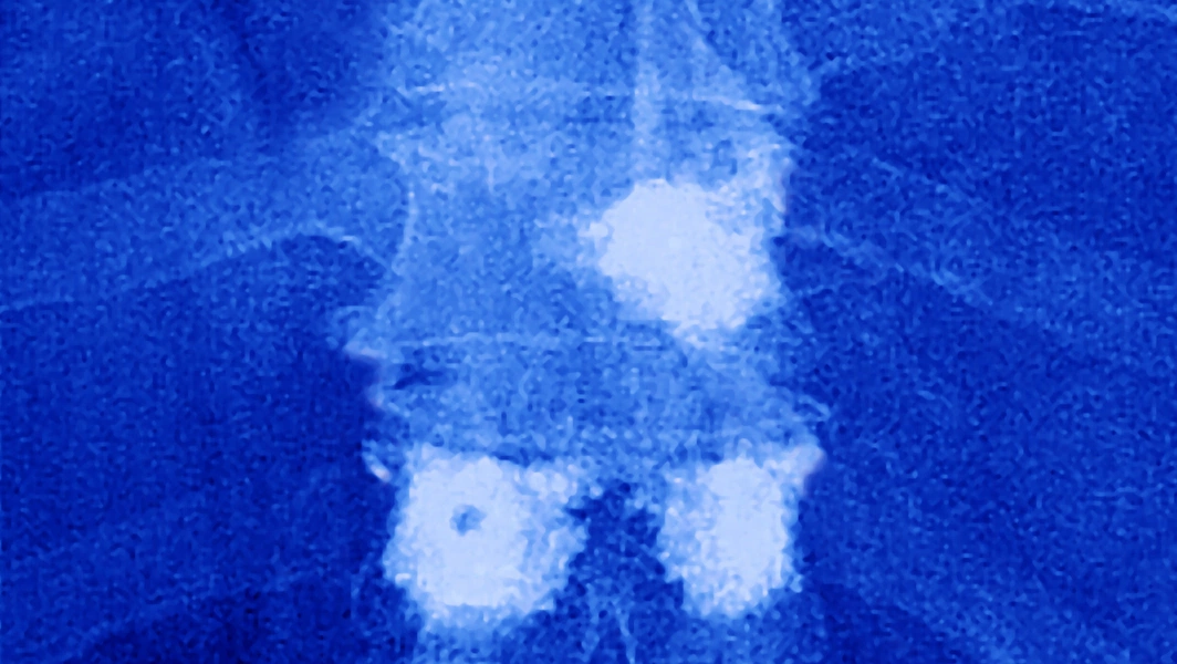 Your friendly guide to bisphosphonates and bone strength