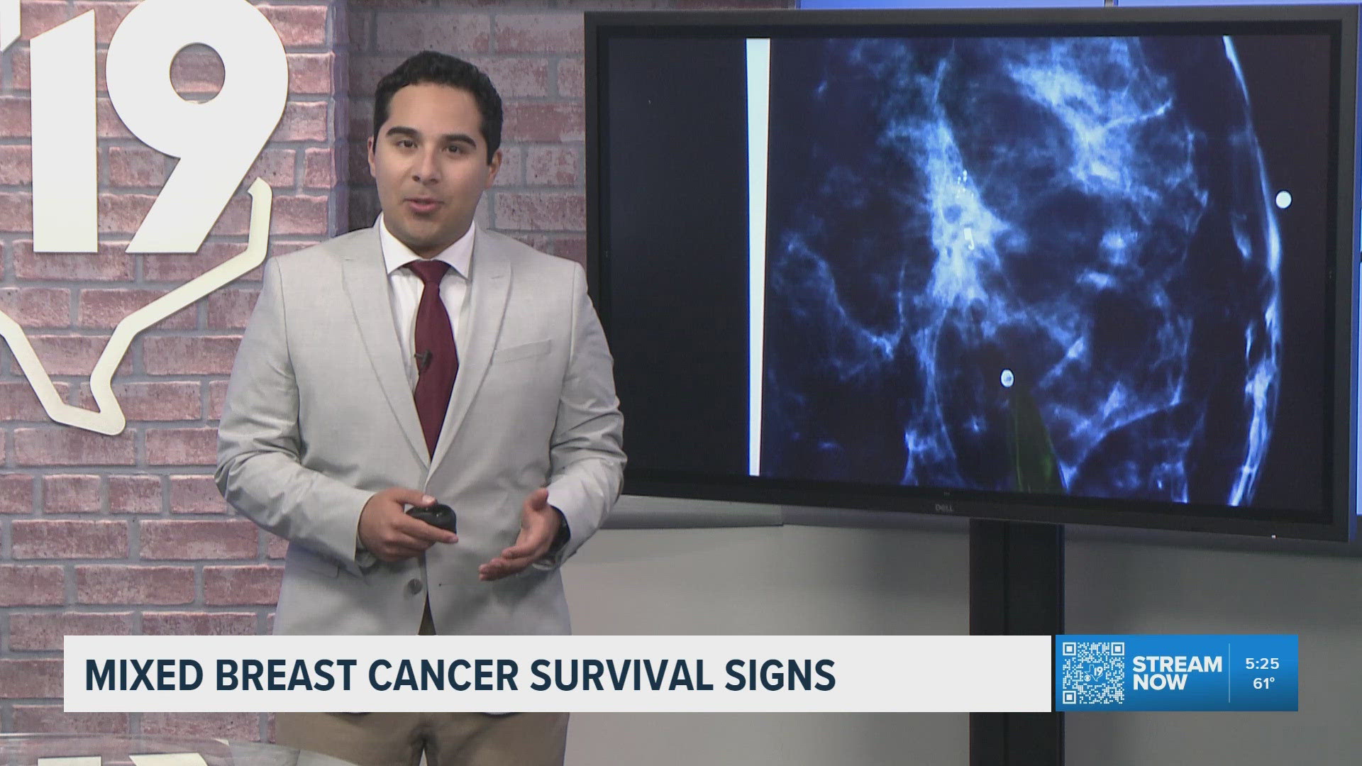Study finds rise in stage 4 breast cancer diagnoses despite survival gains