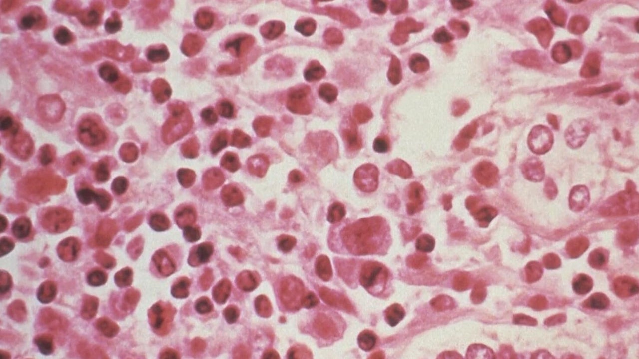 Officials track hantavirus cases from Dutch cruise ship