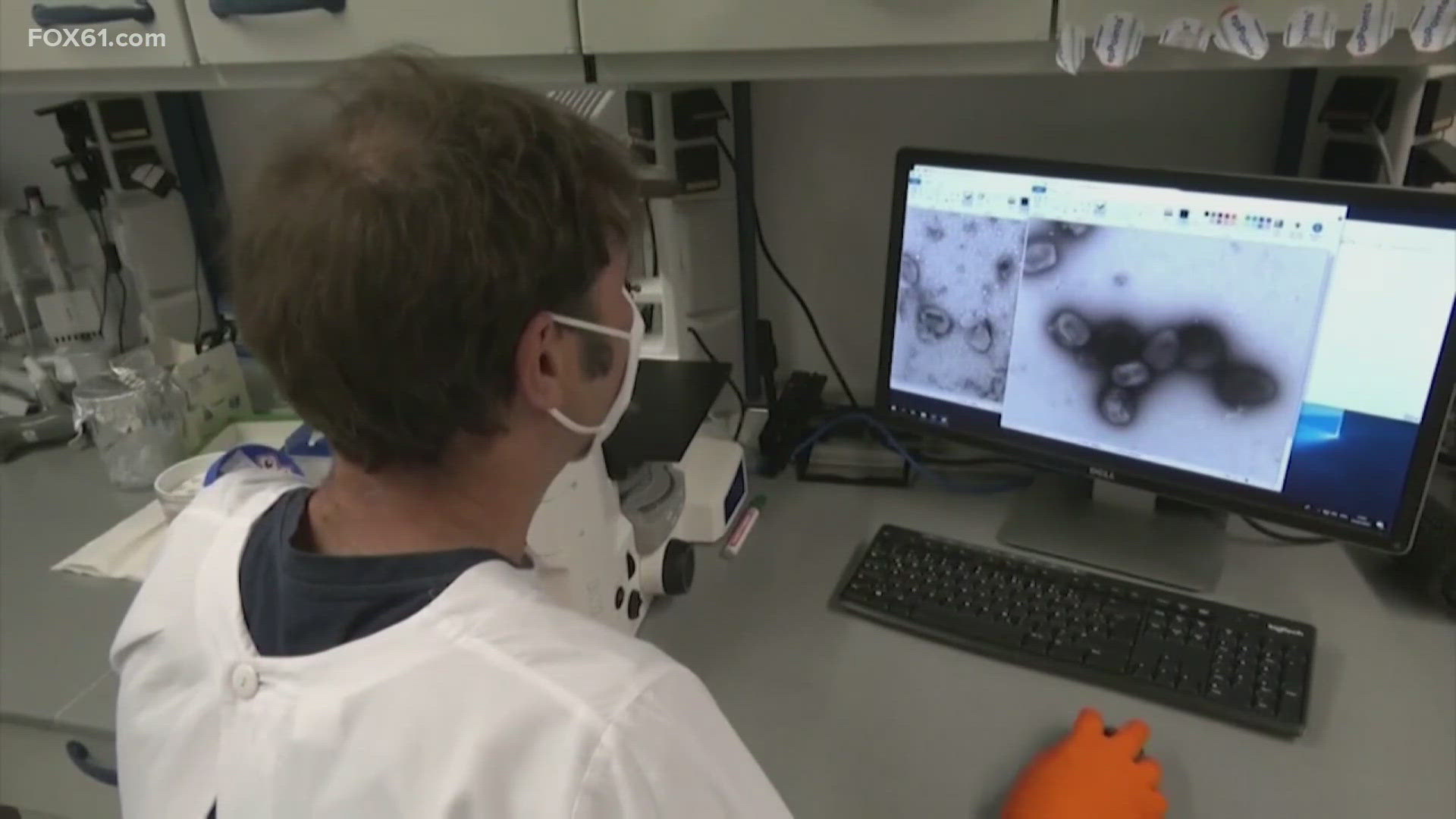 First case of clade I MPOX confirmed in Connecticut
