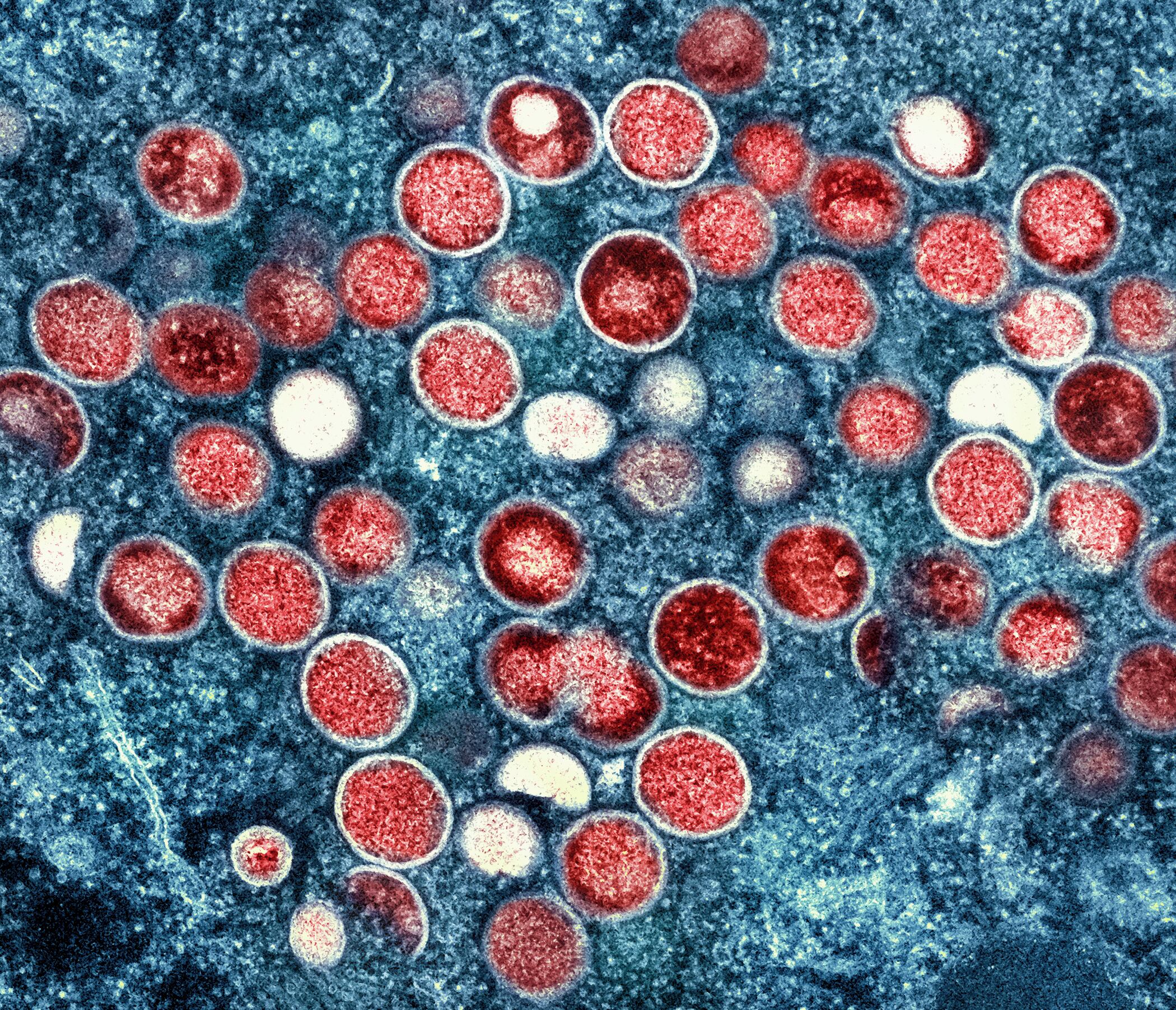 Connecticut Confirms First Monkeypox Virus Case