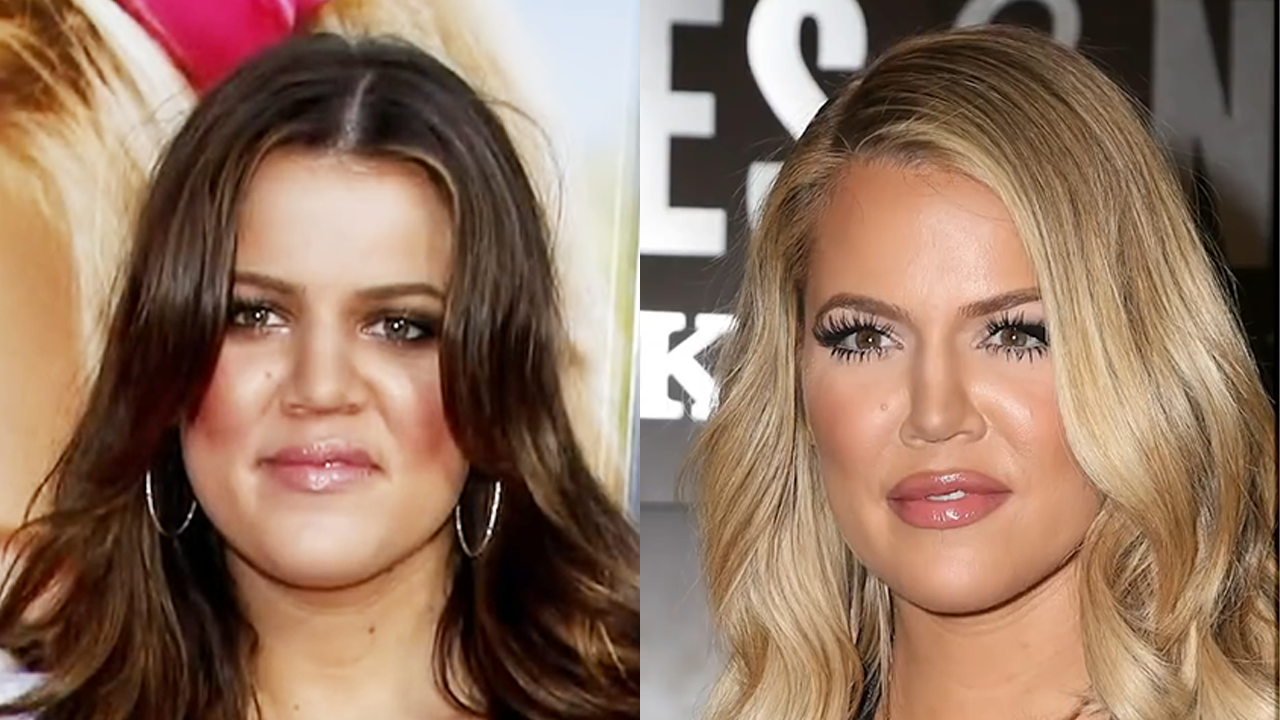Doctor analyzes Khloé Kardashian’s cosmetic transformation