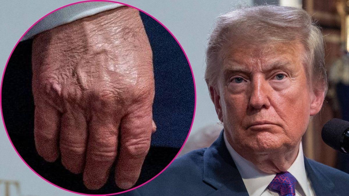 Donald Trump fuels health concerns as bruised hand looks 'nastier than ...
