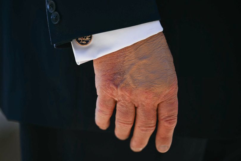 Trump's 'dead man’s hand' exposed again with '5 layers of makeup'