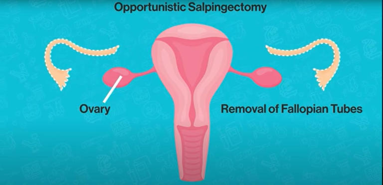 Wanting to be child-free, these women got fallopian tube removal. The ...