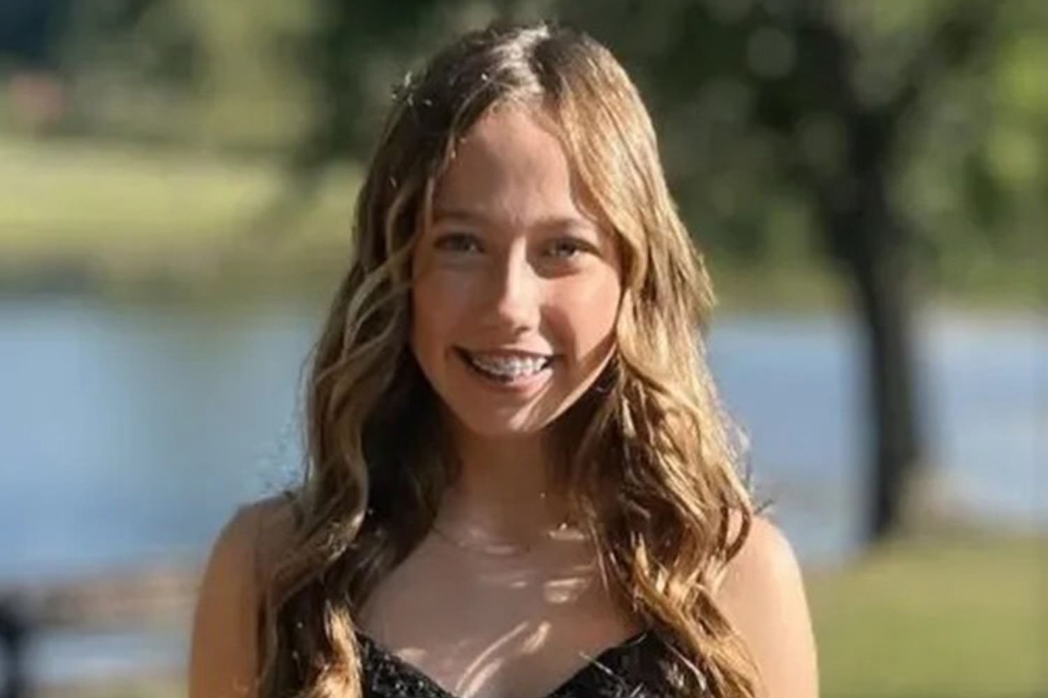 Girl, 15, suffers severe burns on almost half of her body after ...