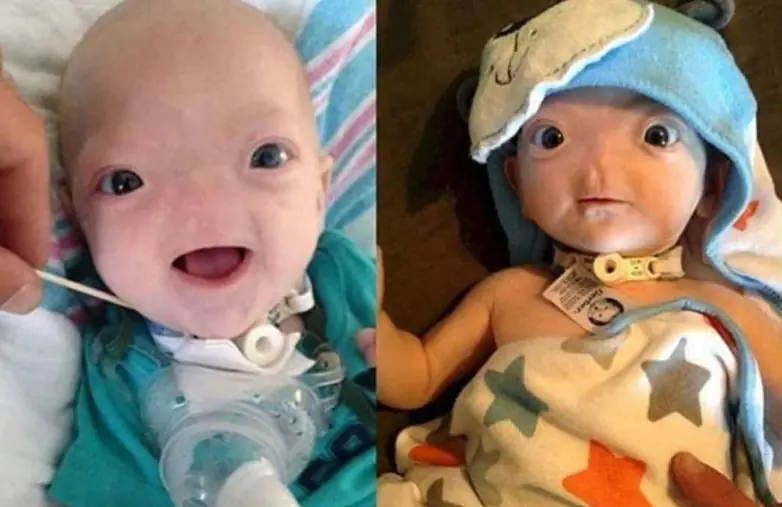 Bebê nasce sem nariz e pais optam por não fazer cirurgia: "Ele é perfeito"