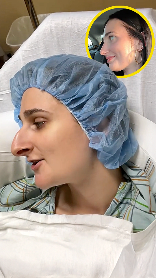 I have the most viral nose job 😅