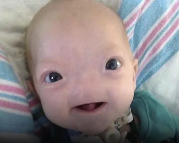 Bebê nasce sem nariz e pais optam por não fazer cirurgia: "Ele é perfeito"