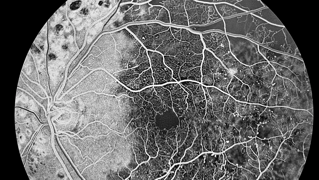 Protect your sight from diabetic retinopathy risks