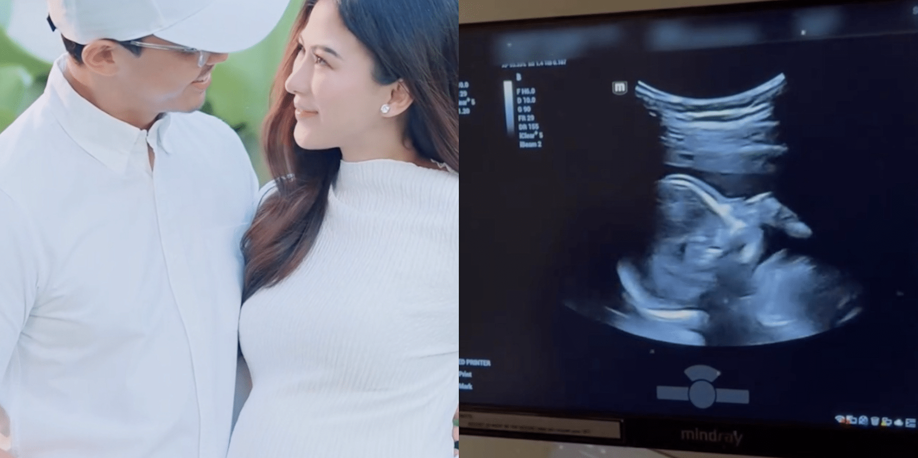 Alex Gonzaga, Mikee Morada expecting first child