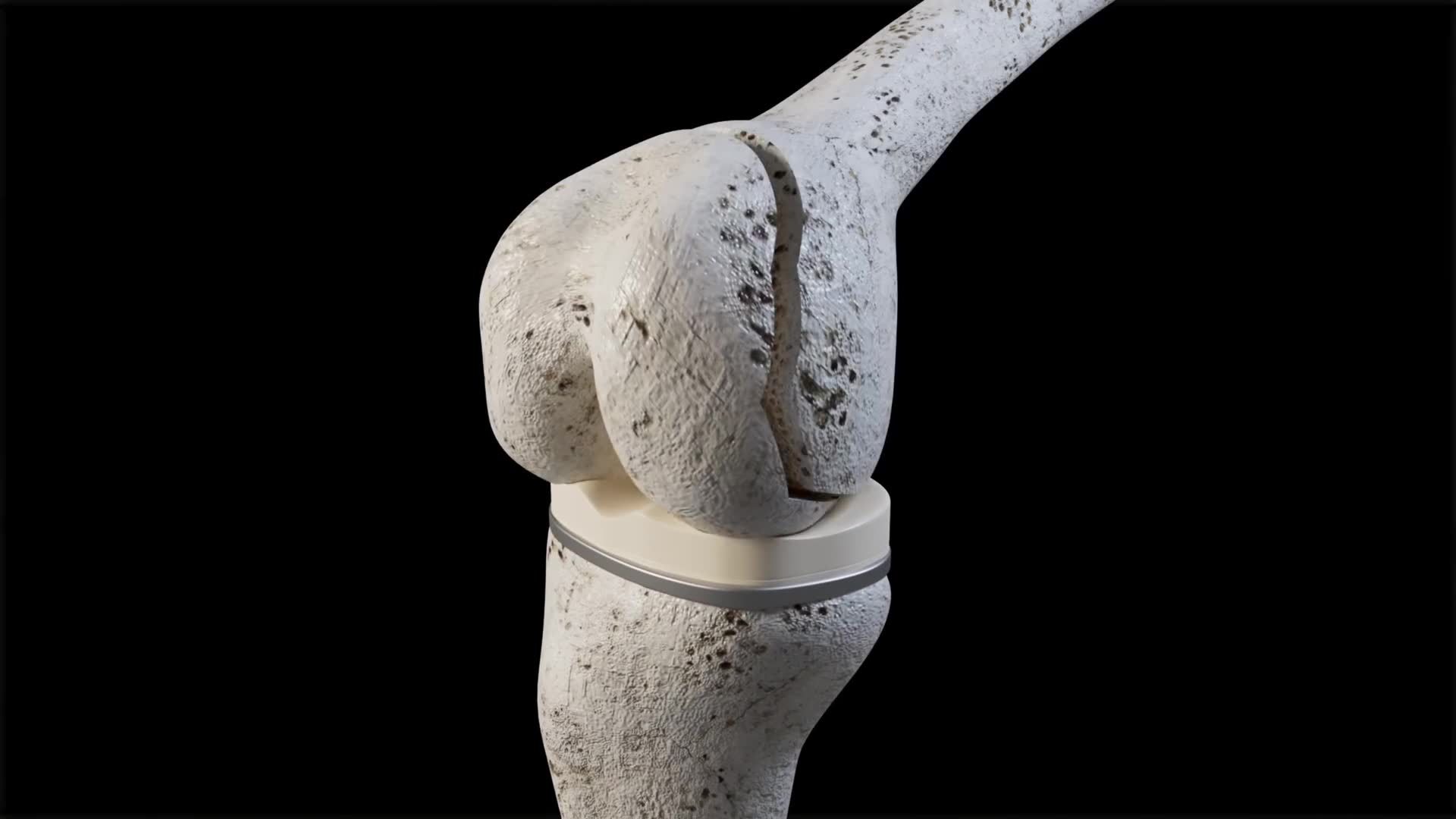 What to expect from knee replacement outcomes