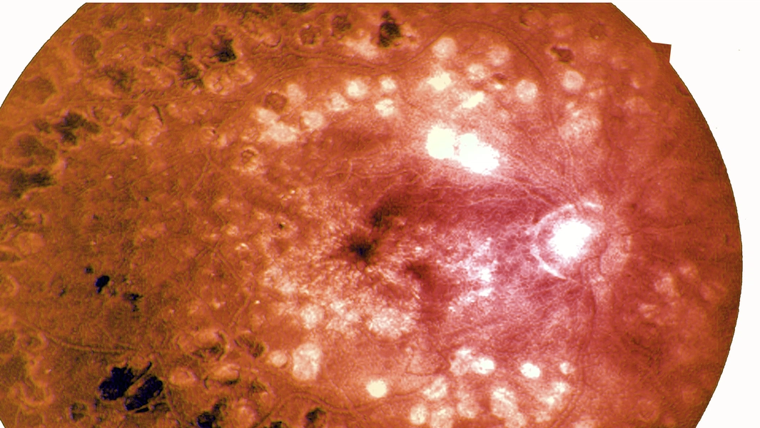 Protect your sight from diabetic retinopathy risks