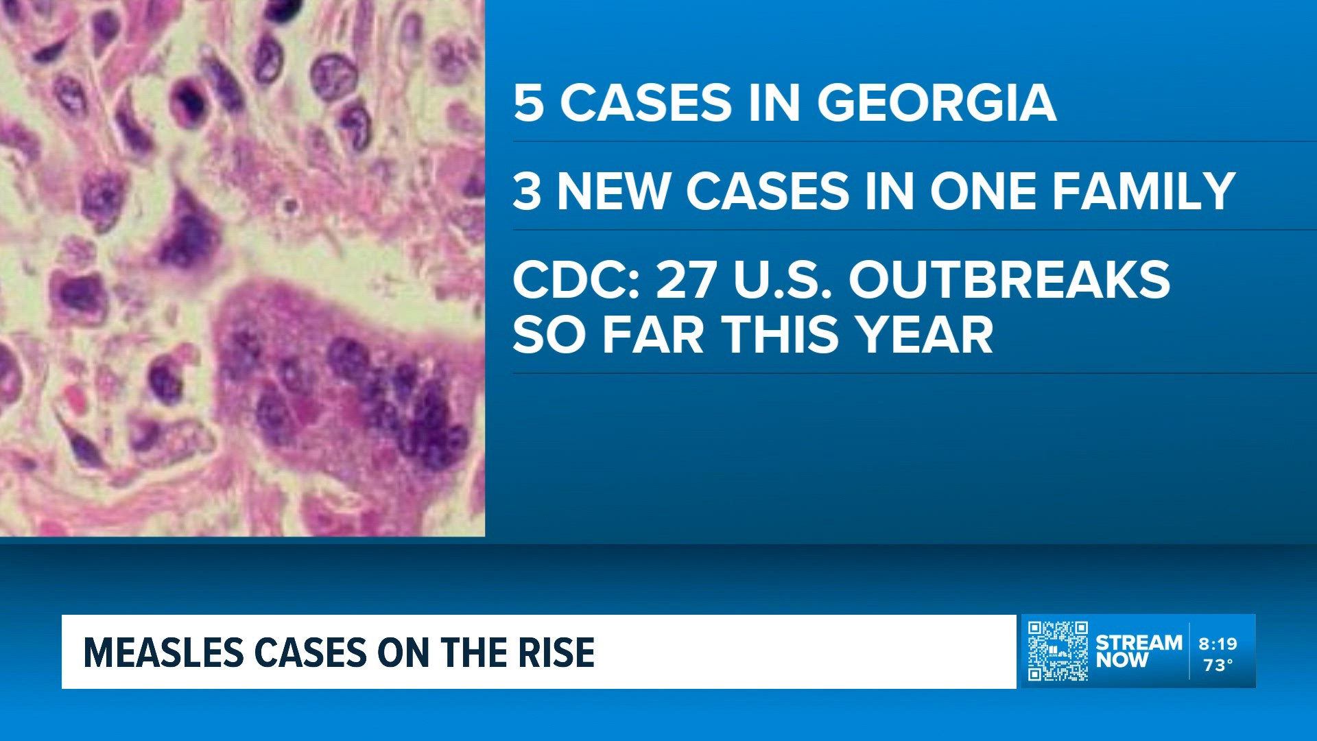 Expert discusses Georgia measles outbreak