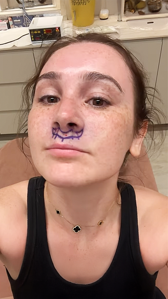 I got my lip flipped 😳