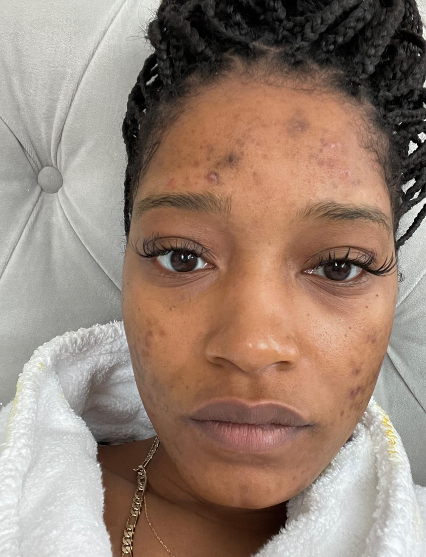 Keke Palmer details condition that left her with 'cracked glass' skin ...