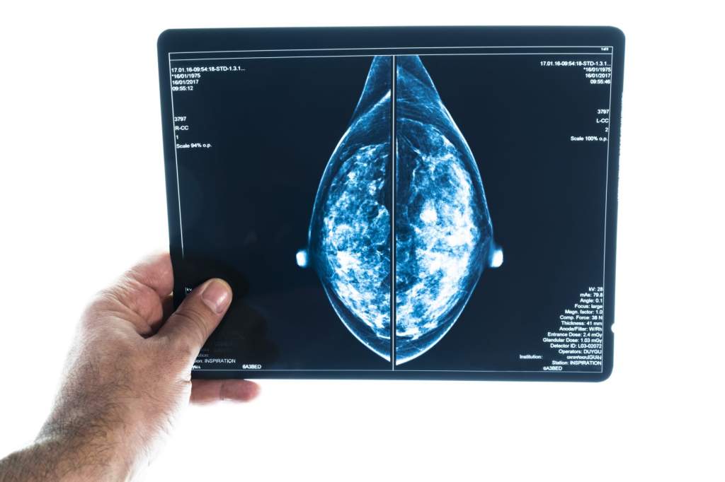 These are the Canadian regions with the highest rates of breast cancer