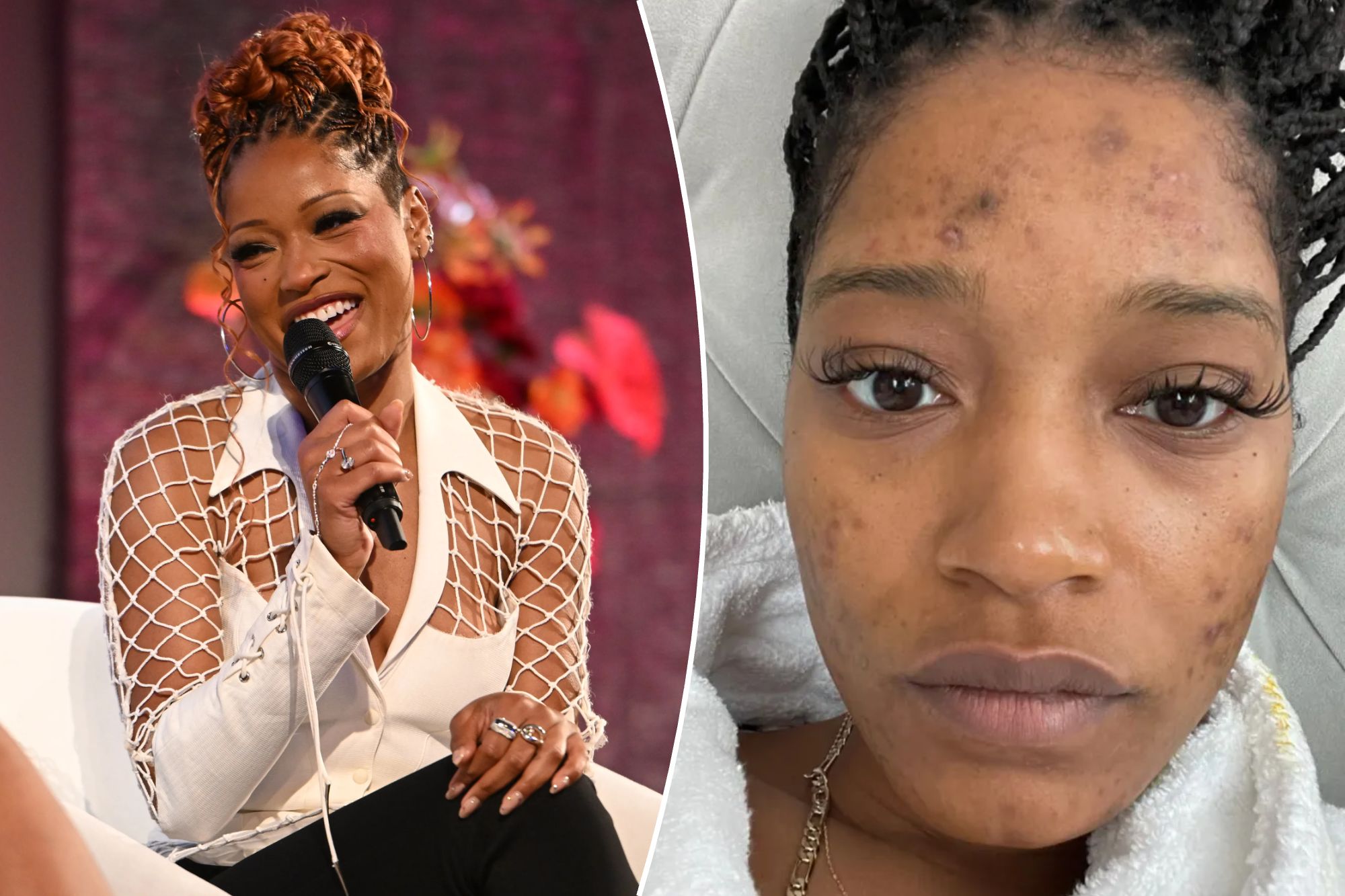 Keke Palmer details condition that left her with 'cracked glass' skin ...