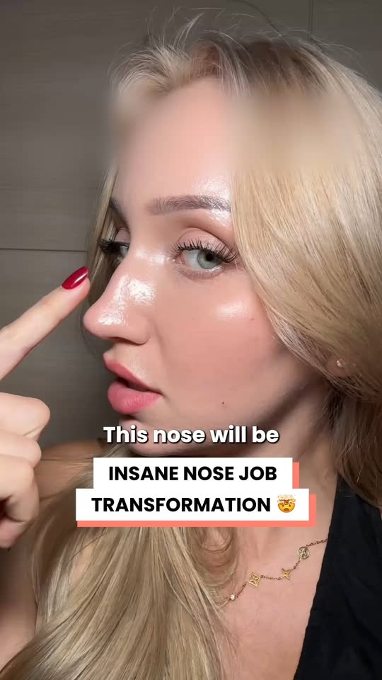 Insane nose job transformation
