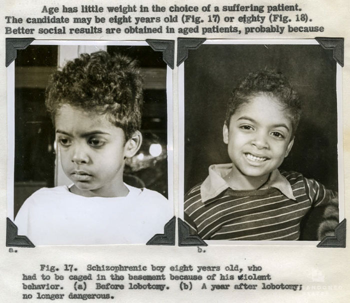 20 disturbing pictures of lobotomy before and after
