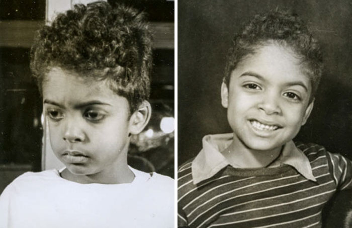 20 disturbing pictures of lobotomy before and after