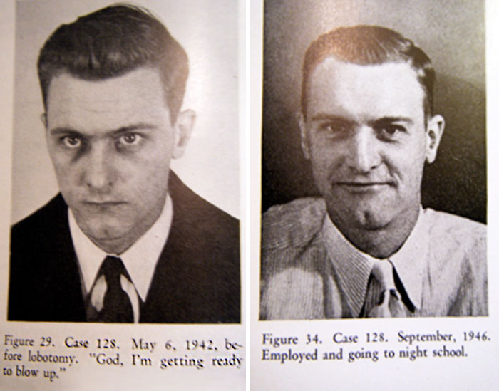 20 disturbing pictures of lobotomy before and after