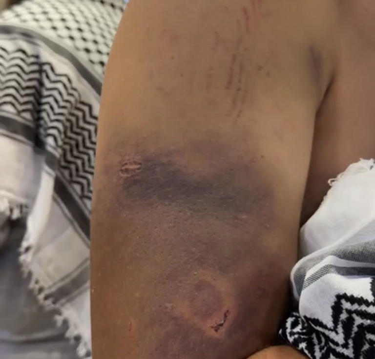 Gaza flotilla activists reveal wounds suffered in Israeli detention