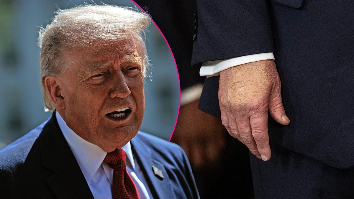 Donald Trump slathers makeup on his swollen hand for graduation address ...