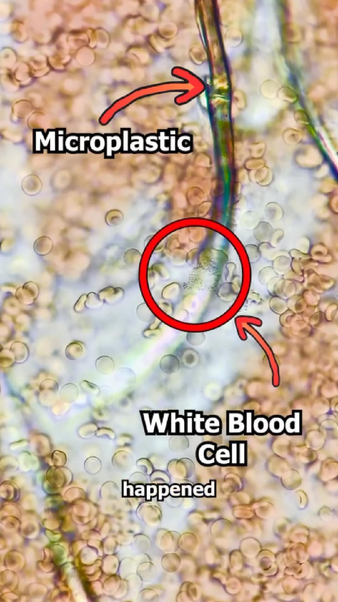 Captured white blood cells attacking microplastics