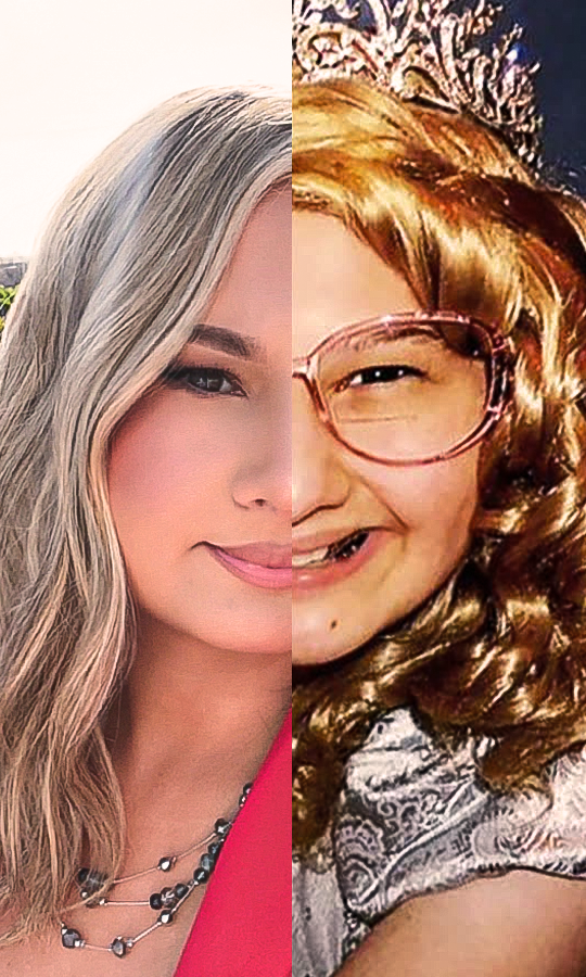 What did Gypsy Rose look like before surgery?