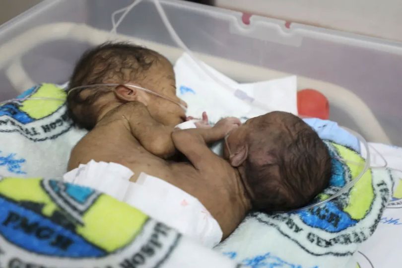 Doctors detail complicated mission to save conjoined twins as mother ...