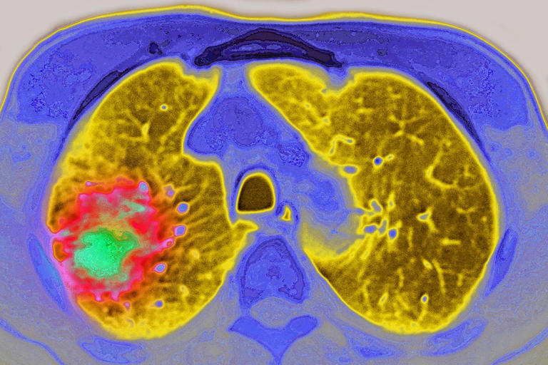 GLP-1 weight loss drugs may reduce the chance of certain cancers ...
