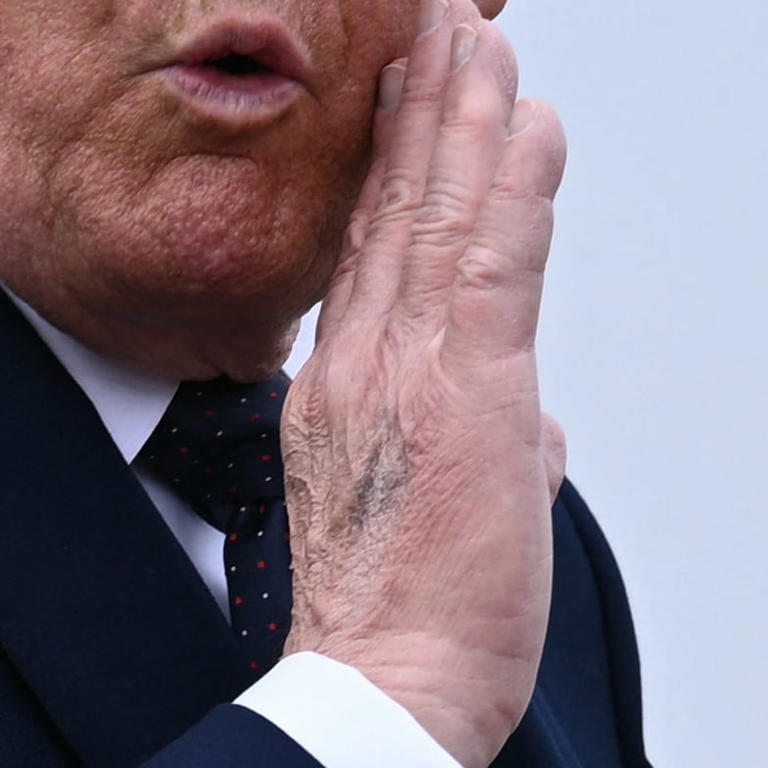 Trump, 79, flashes heavily bruised hand ahead of holiday weekend