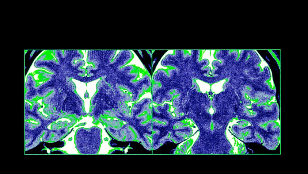 Study finds brain memory hub starts full, prunes for efficiency